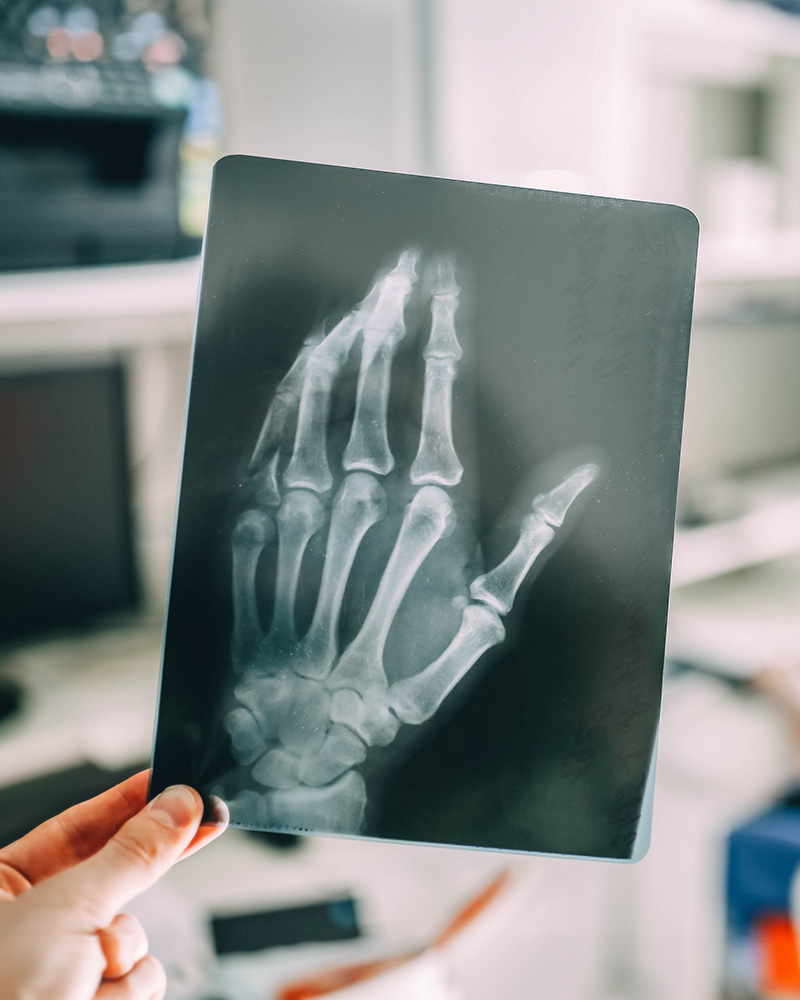 Hand Fracture I Orthopaedics I St Vincent’s Private Hospitals
